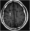 Signs in Neuroradiology: A Pictorial Review | deemag and chest clinic